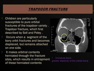 Orbital fractures ih | PPT