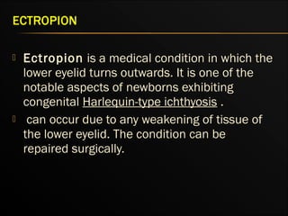 Orbital fractures ih | PPT