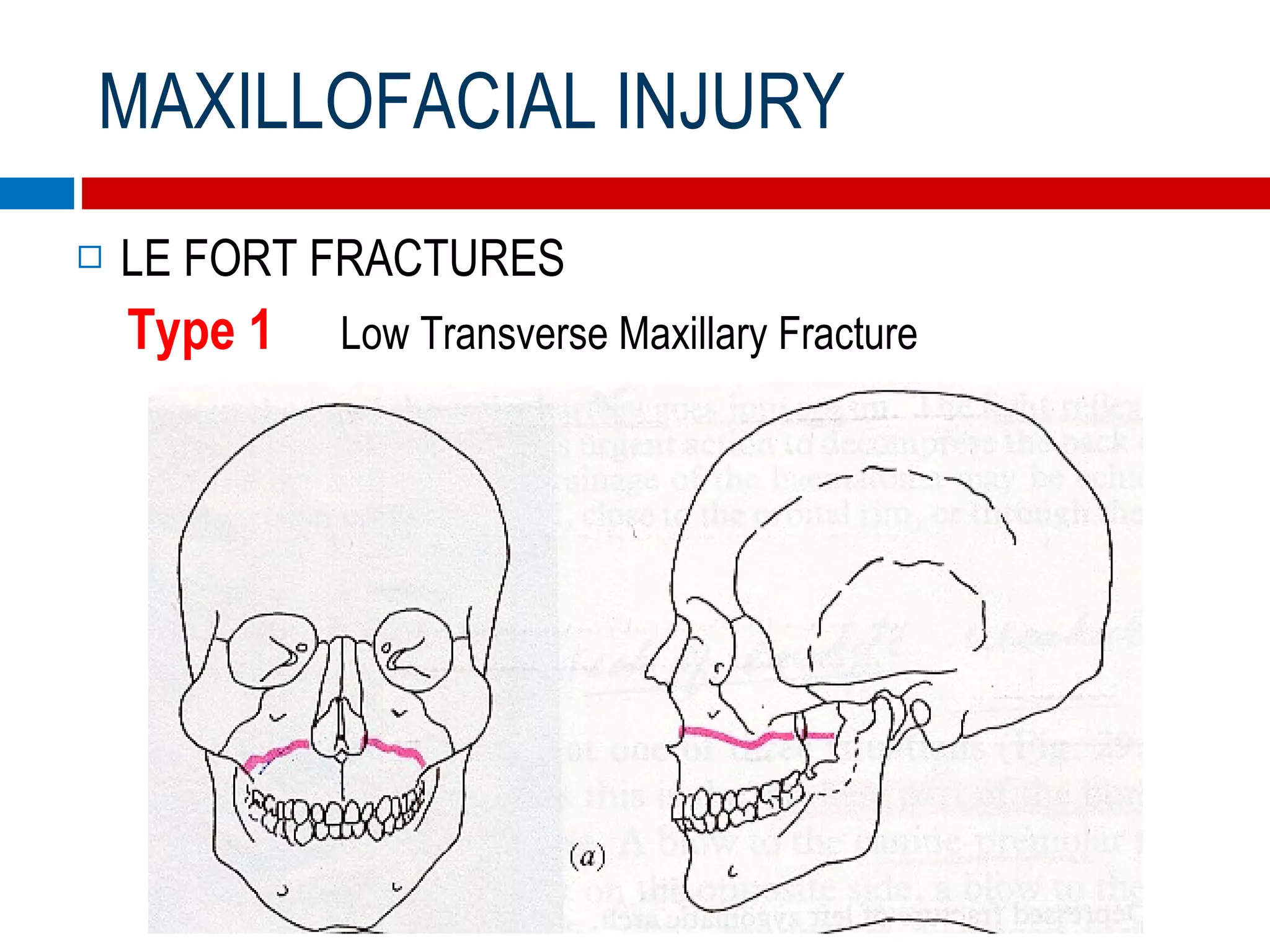 Orbital Fractures - The Role of an Ophthalmologist | PPT