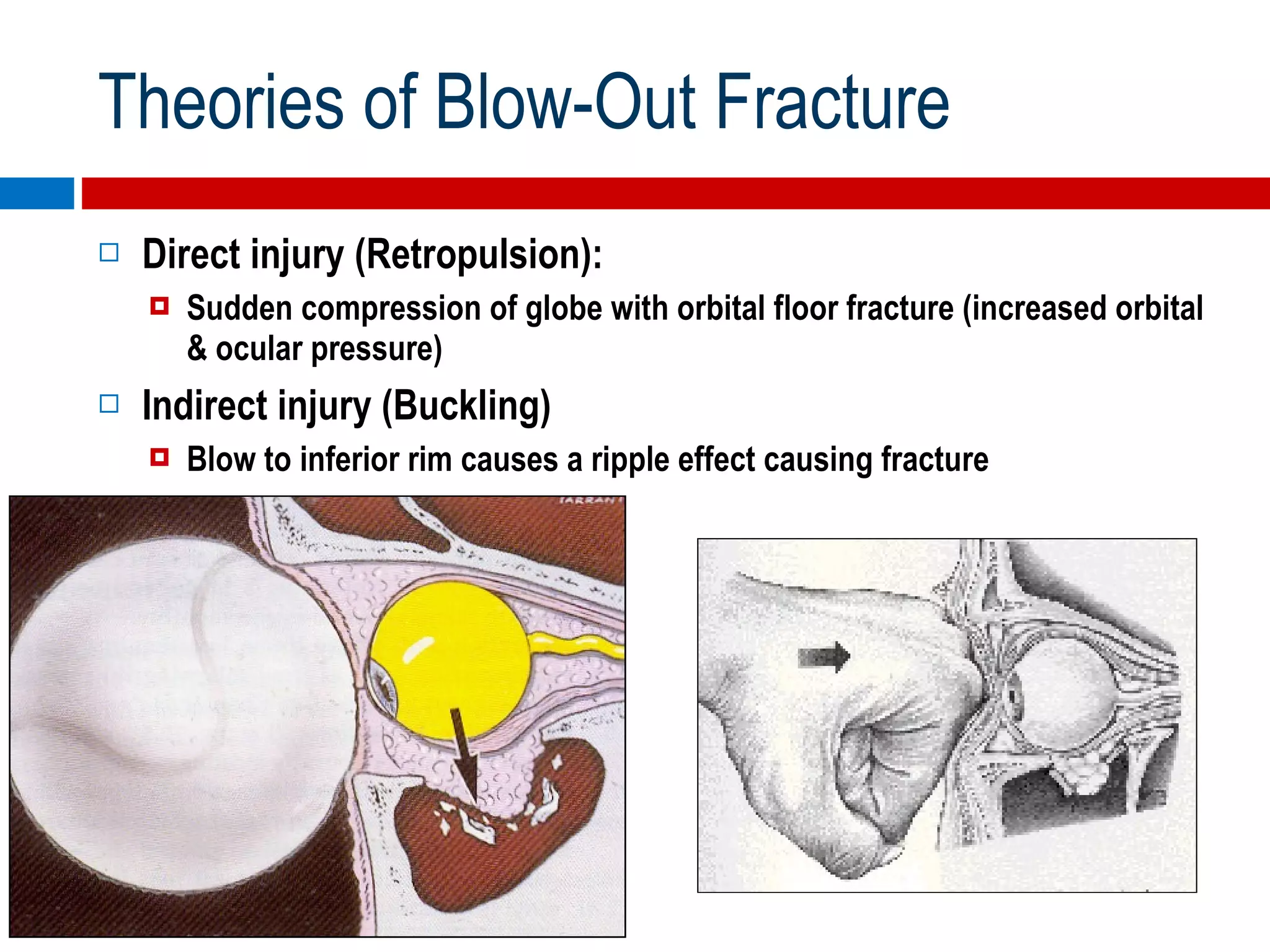 Orbital Fractures - The Role of an Ophthalmologist | PPT