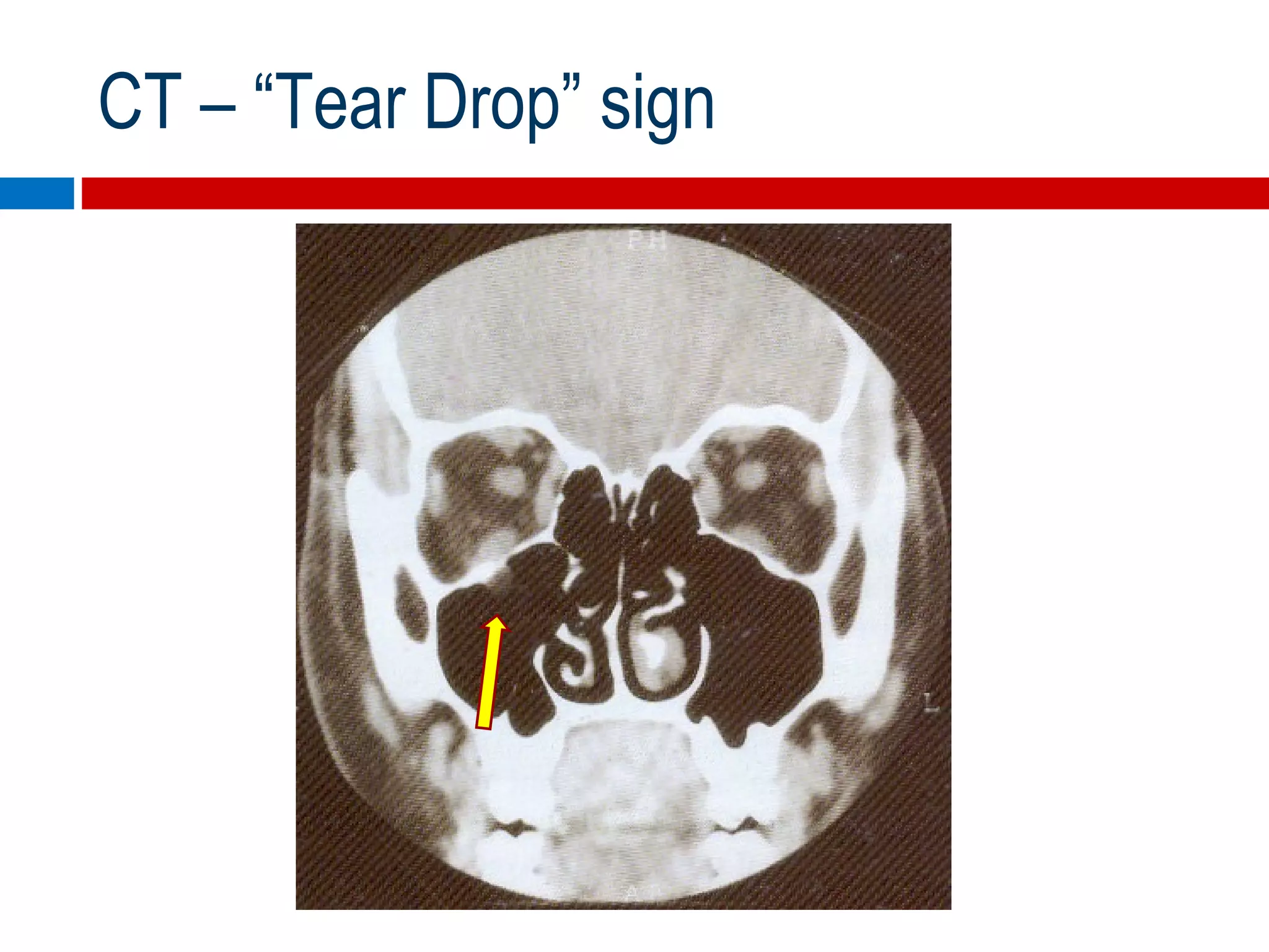 Orbital Fractures - The Role of an Ophthalmologist | PPT