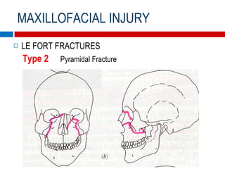 Orbital Fractures - The Role of an Ophthalmologist | PPT