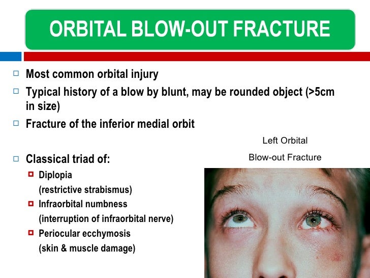 Orbital Fractures - The Role of an Ophthalmologist