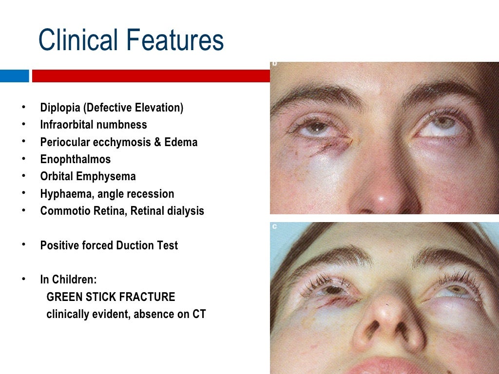 Orbital Fractures - The Role of an Ophthalmologist