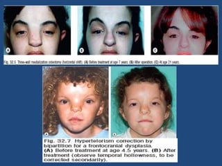 Hypertelorism Measurement