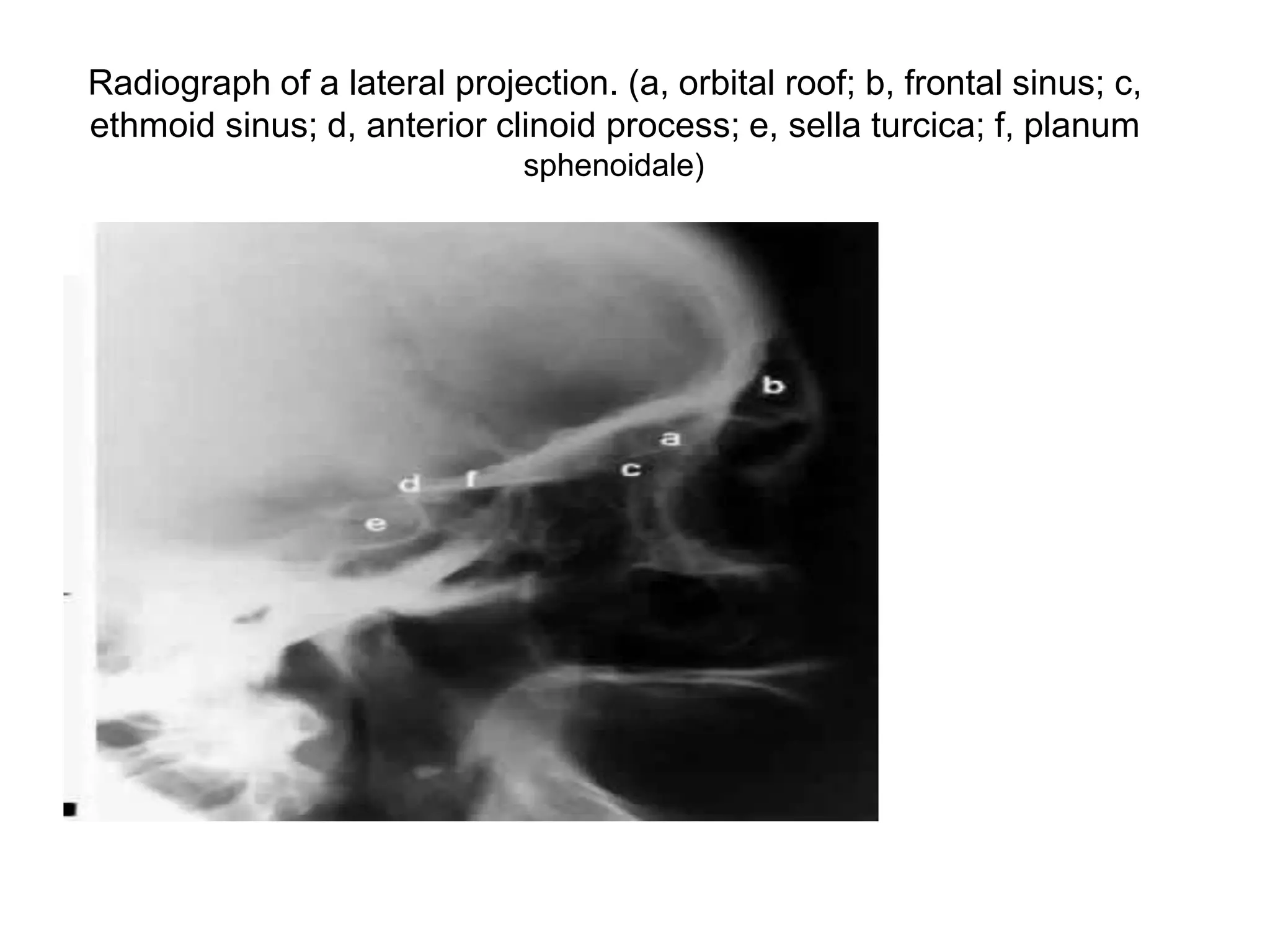 Orbital imaging (X-RAY,CT SCAN,AND MRI) | PPT