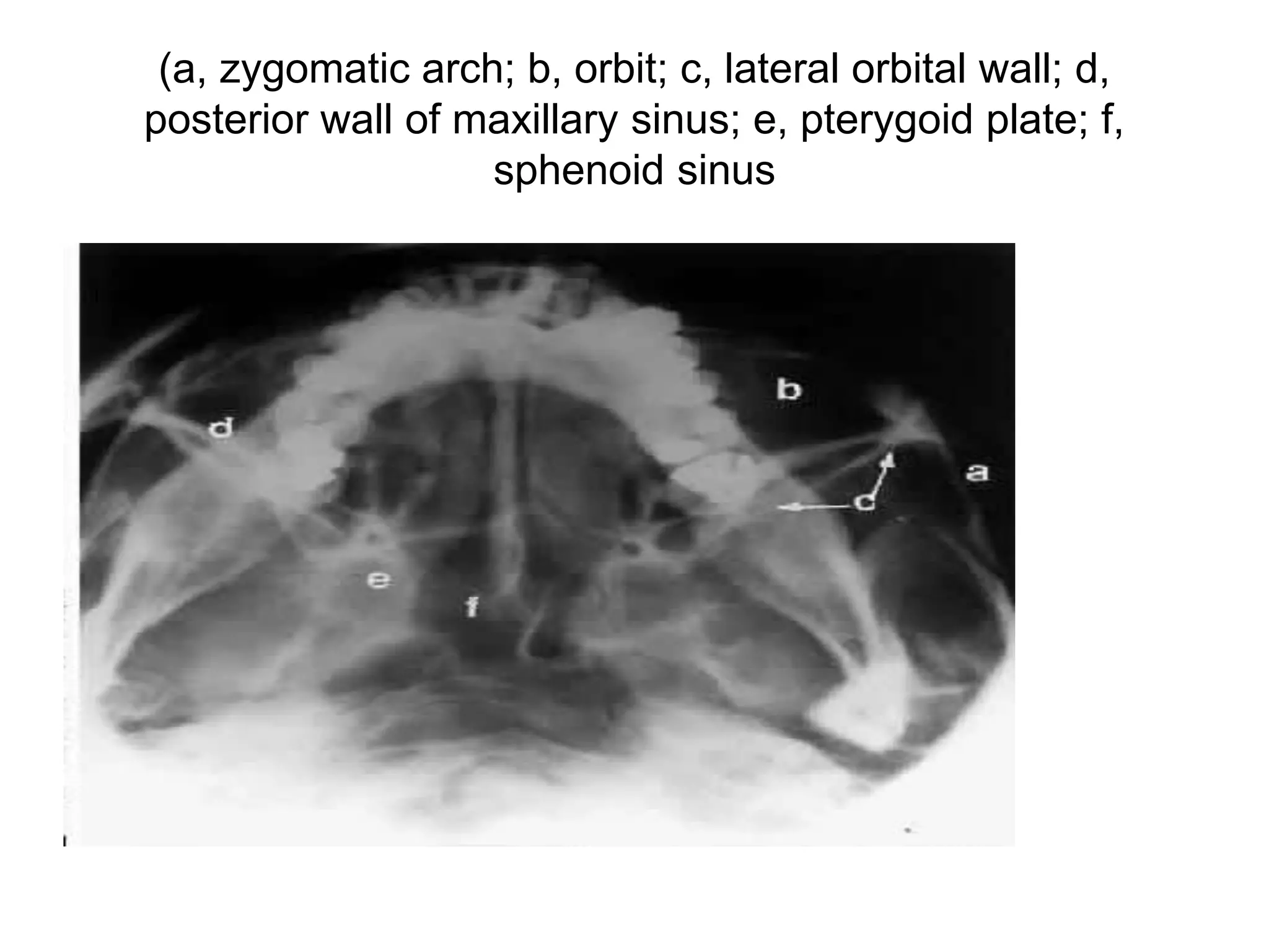 Orbital imaging (X-RAY,CT SCAN,AND MRI) | PPT