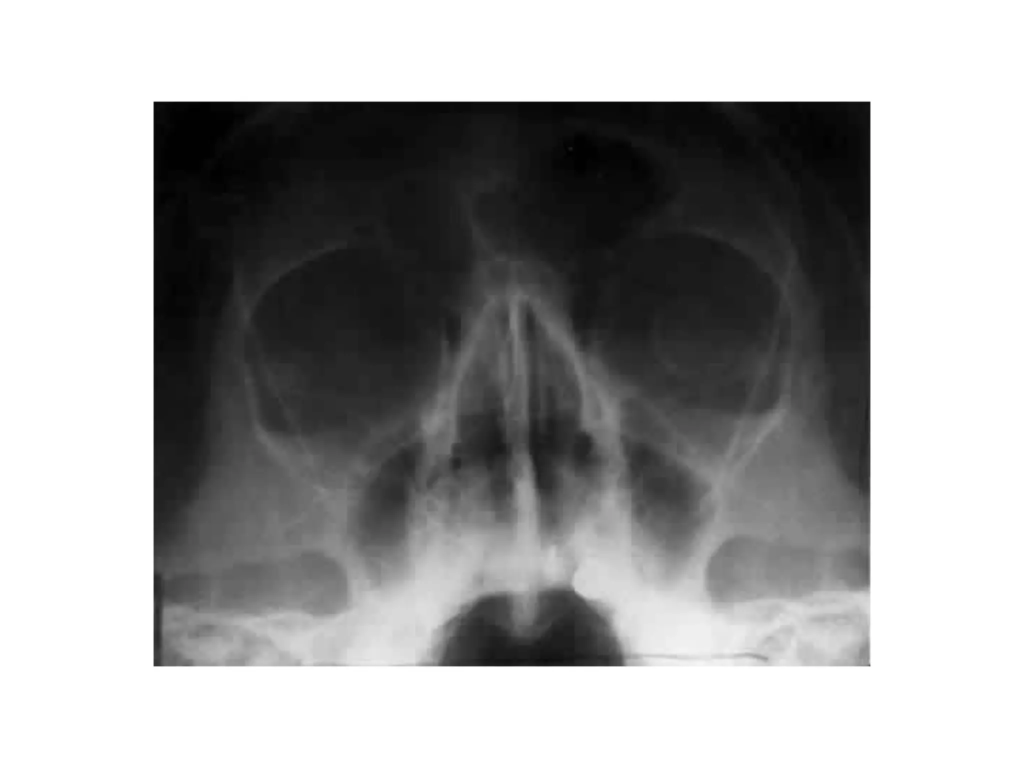 Orbital imaging (X-RAY,CT SCAN,AND MRI) | PPT
