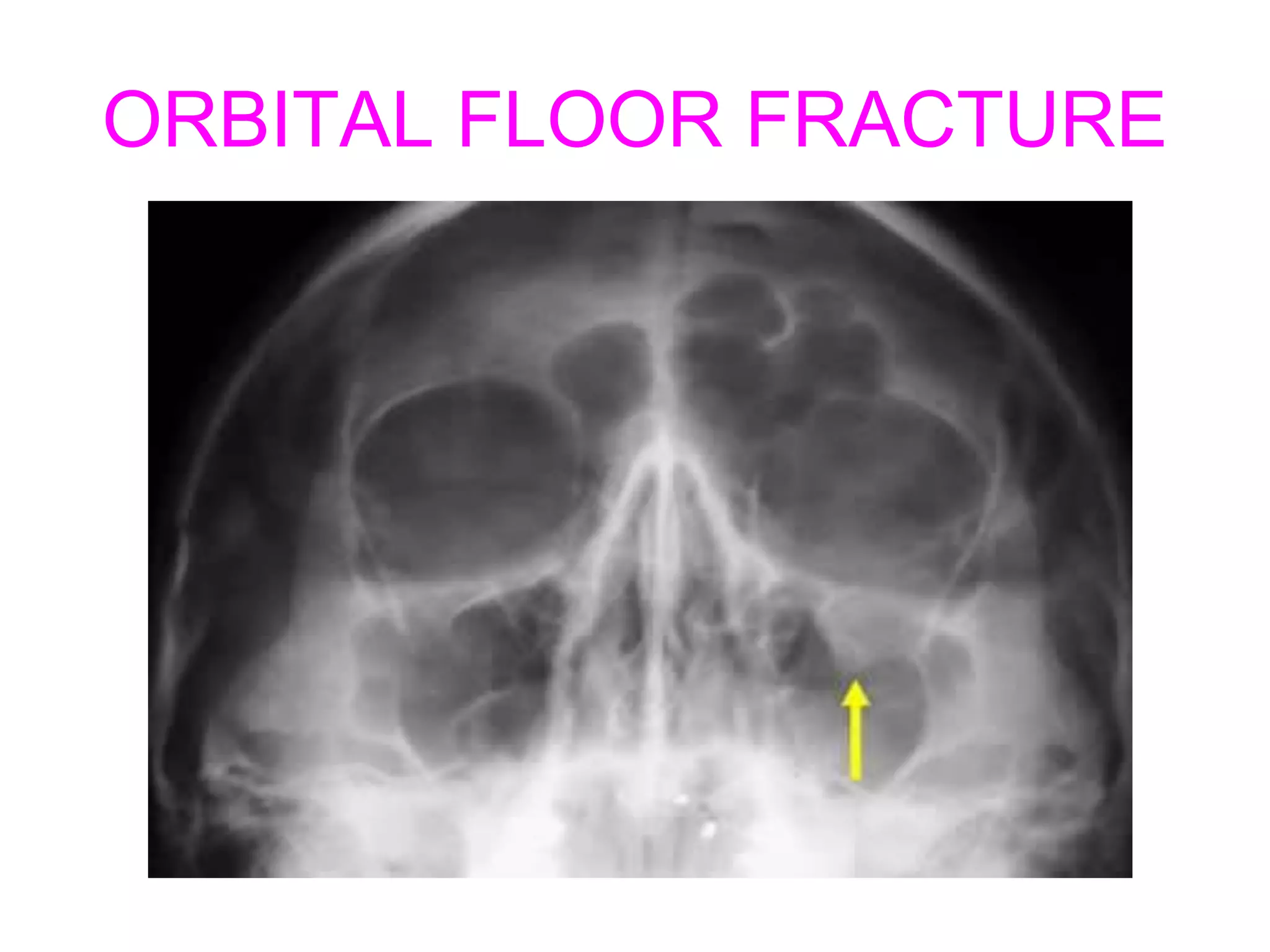Orbital imaging (X-RAY,CT SCAN,AND MRI) | PPT