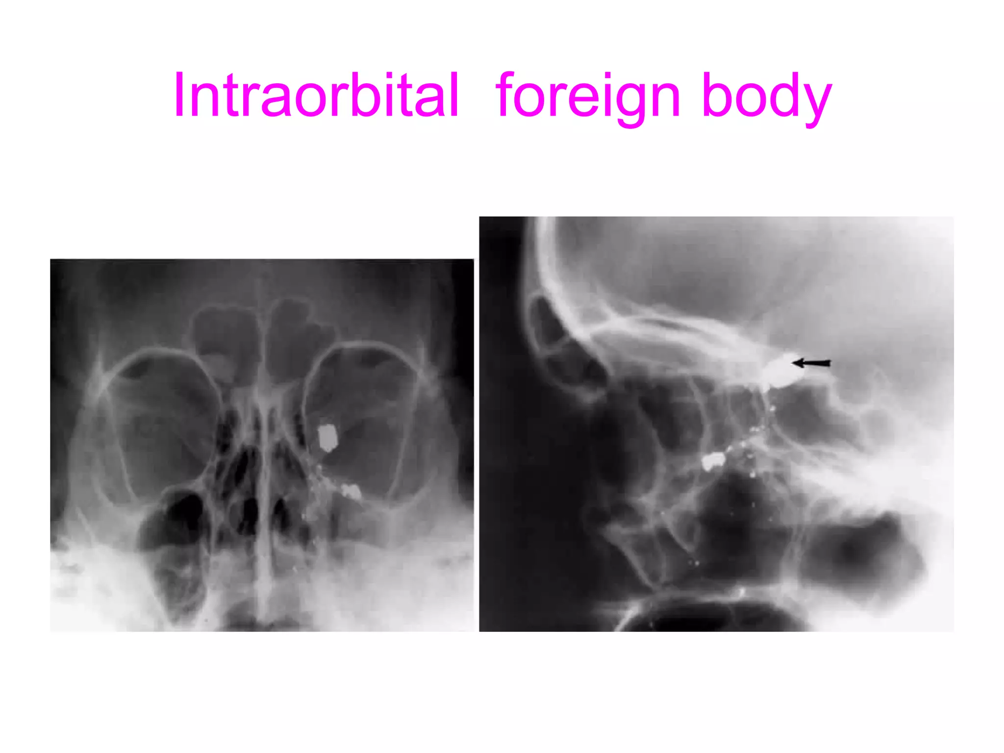 Orbital imaging (X-RAY,CT SCAN,AND MRI) | PPT