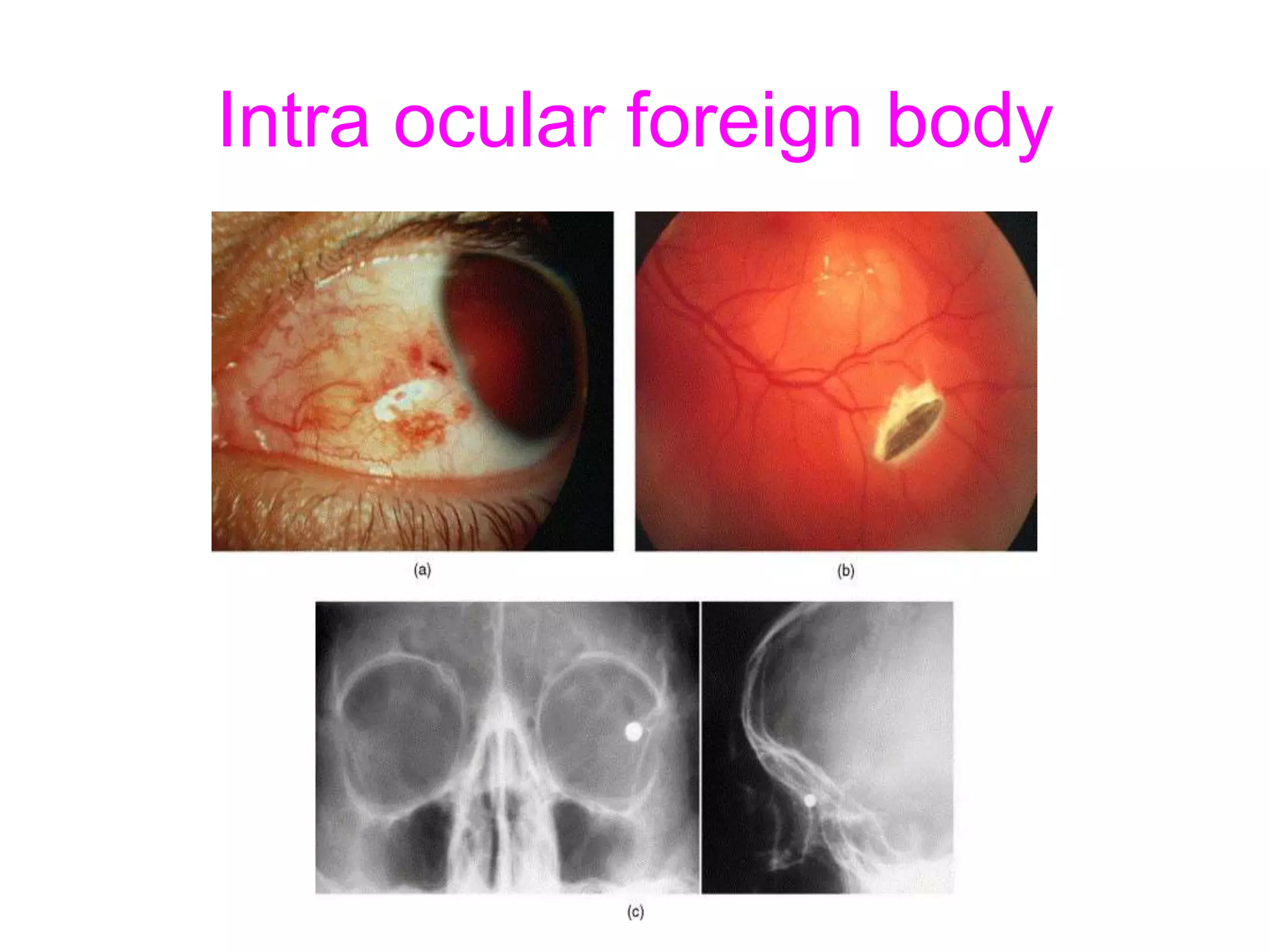 Orbital imaging (X-RAY,CT SCAN,AND MRI) | PPT