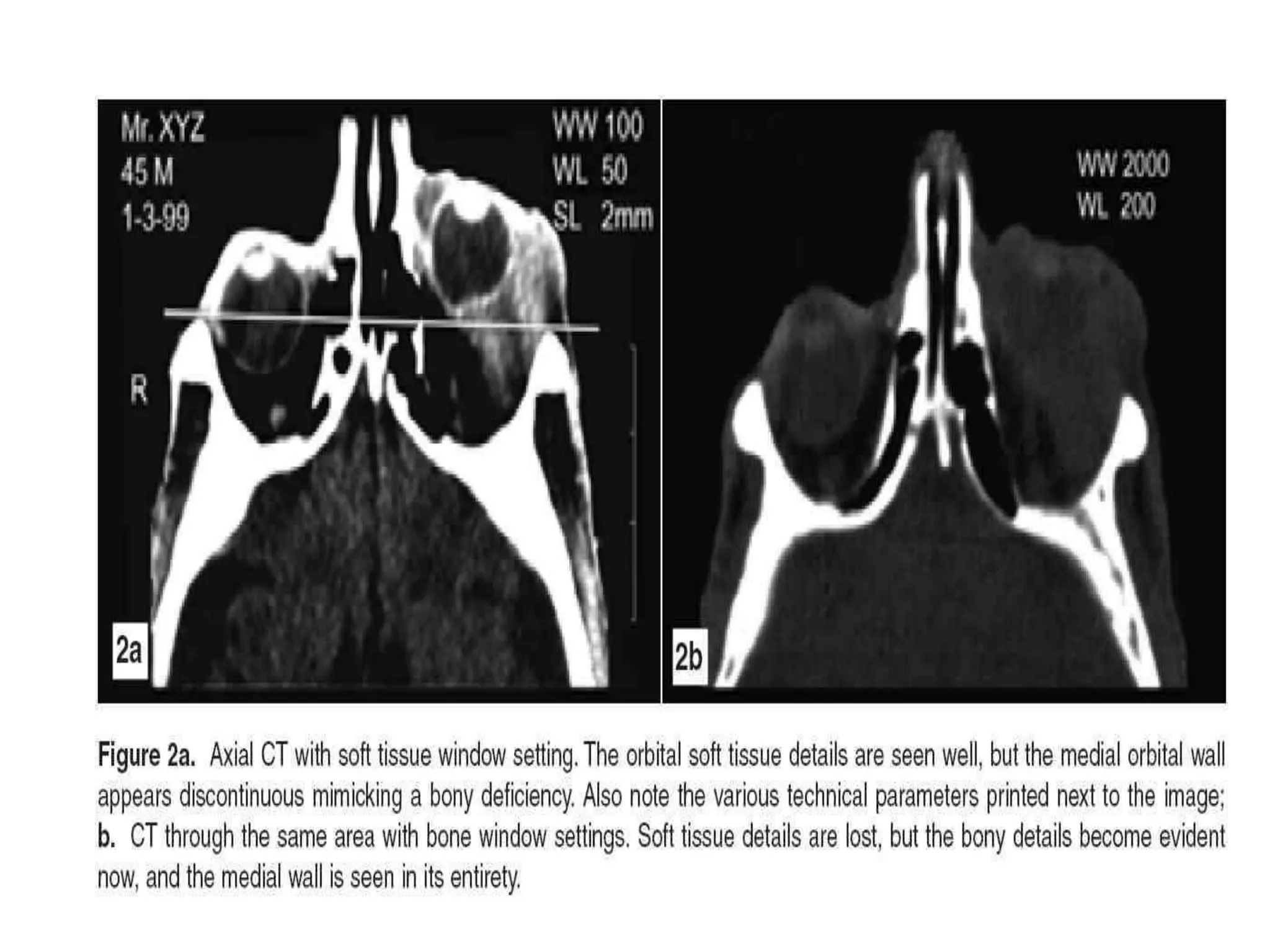 Orbital imaging (X-RAY,CT SCAN,AND MRI) | PPT
