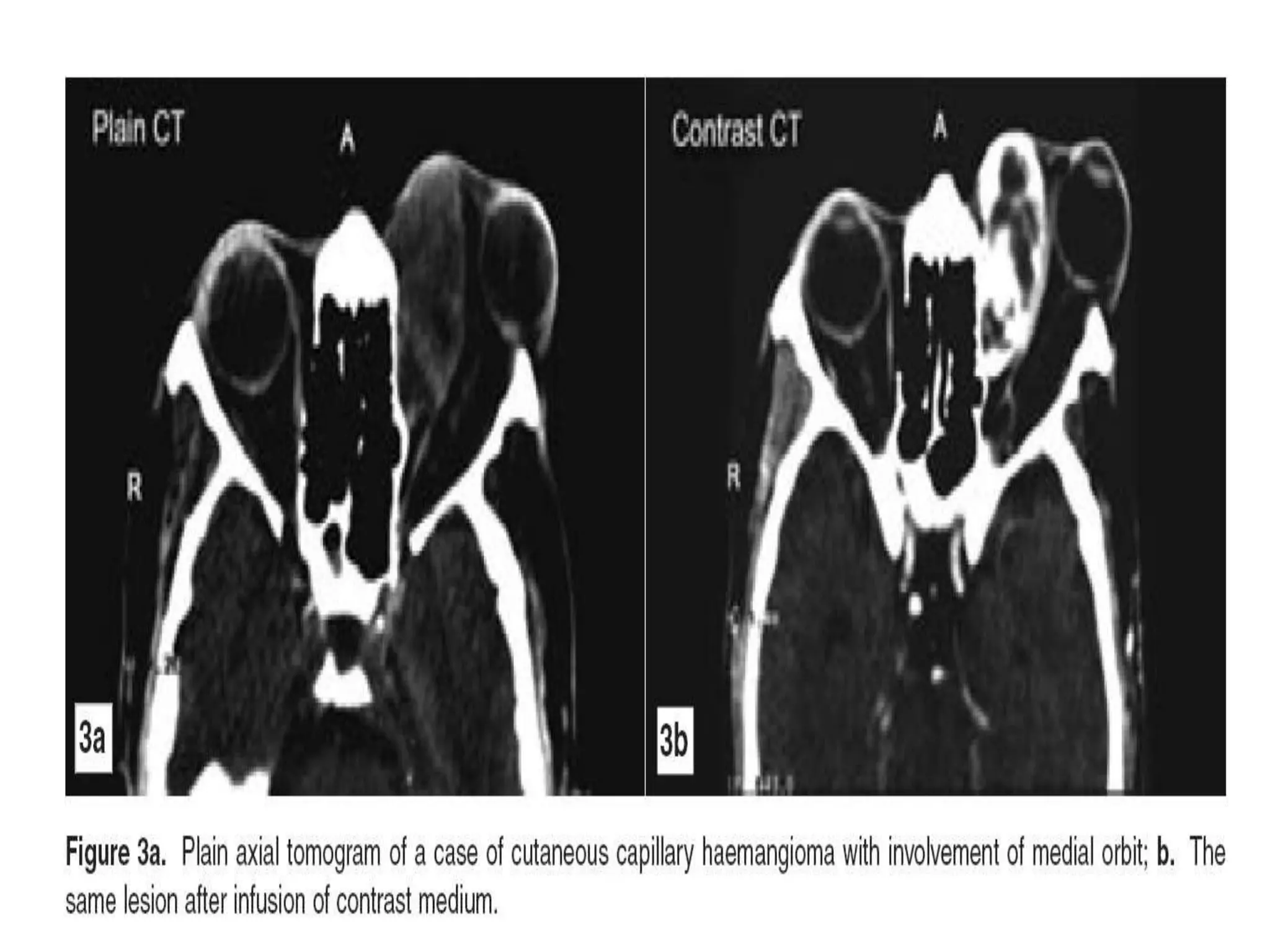 Orbital imaging (X-RAY,CT SCAN,AND MRI) | PPT