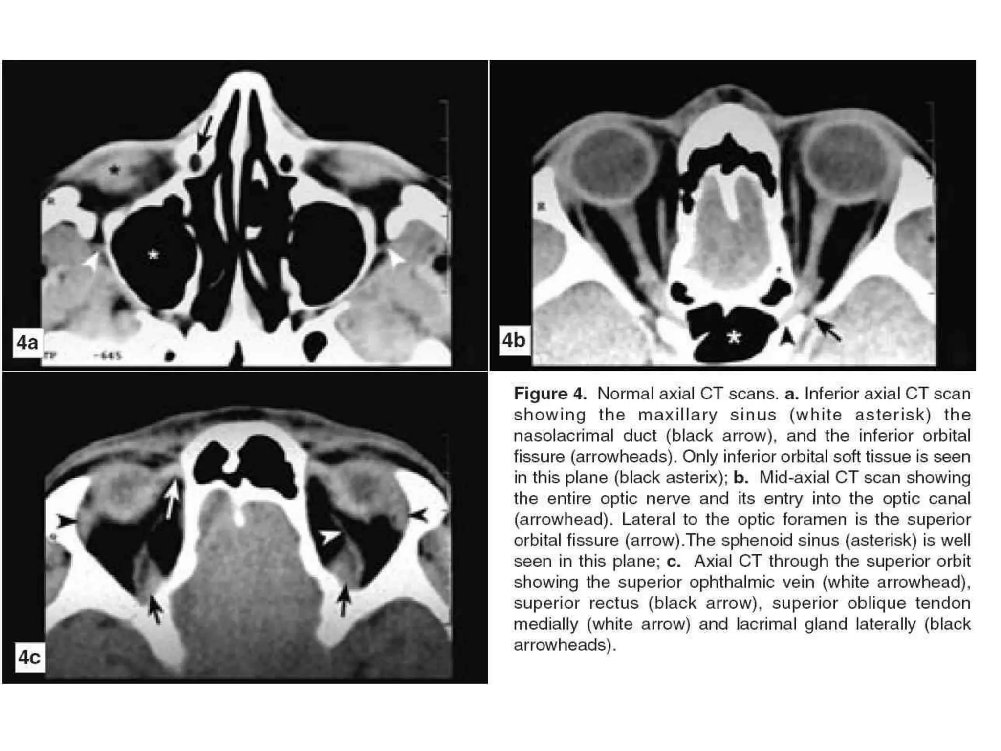 Orbital imaging (X-RAY,CT SCAN,AND MRI) | PPT