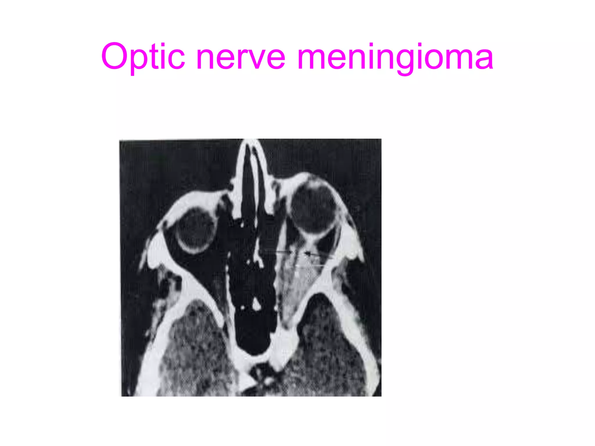 Orbital imaging (X-RAY,CT SCAN,AND MRI) | PPT