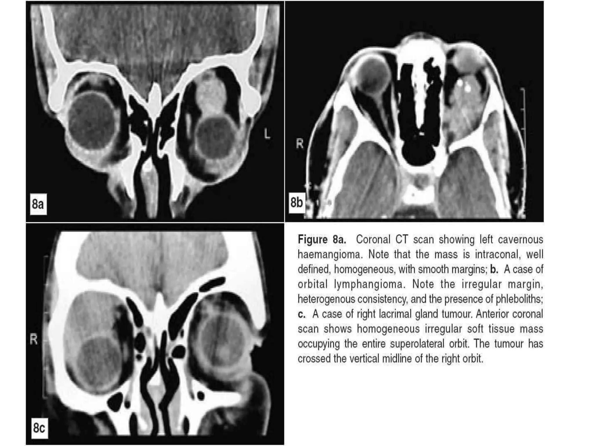 Orbital imaging (X-RAY,CT SCAN,AND MRI) | PPT