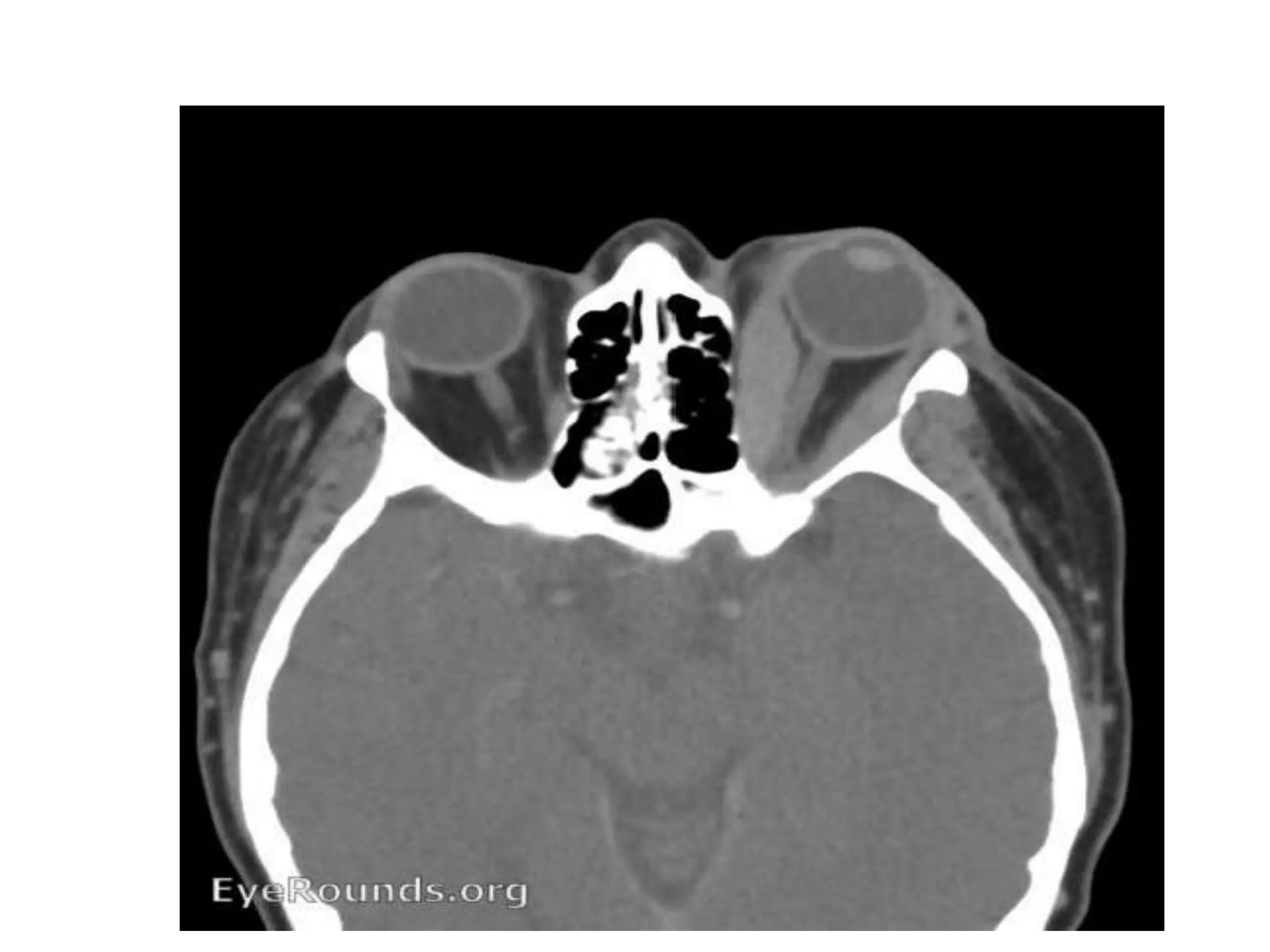 Orbital imaging (X-RAY,CT SCAN,AND MRI) | PPT