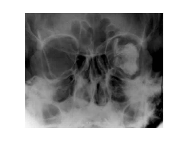 Orbital imaging (X-RAY,CT SCAN,AND MRI) | PPT | Eye and Vision ...