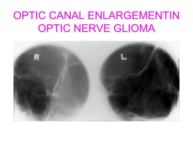 Orbital imaging (X-RAY,CT SCAN,AND MRI) | PPT | Eye and Vision ...