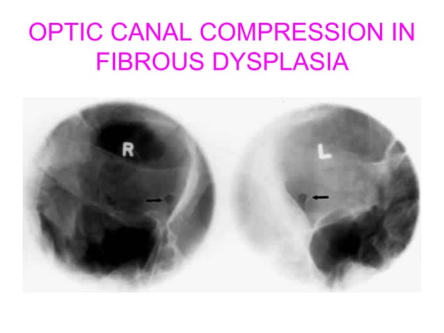 Orbital imaging (X-RAY,CT SCAN,AND MRI) | PPT | Eye and Vision ...