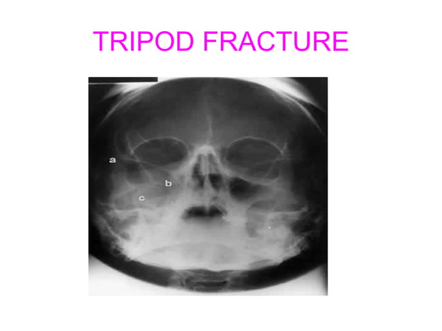 Orbital imaging (X-RAY,CT SCAN,AND MRI) | PPT | Eye and Vision ...