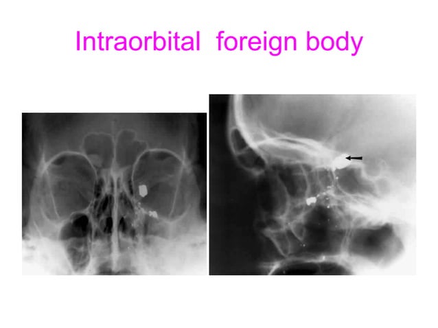 Orbital imaging (X-RAY,CT SCAN,AND MRI) | PPT | Eye and Vision ...
