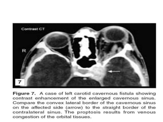 Orbital imaging (X-RAY,CT SCAN,AND MRI) | PPT