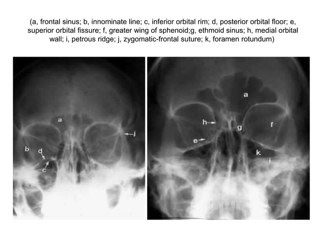 Orbital imaging (X-RAY,CT SCAN,AND MRI) | PPT | Eye and Vision ...