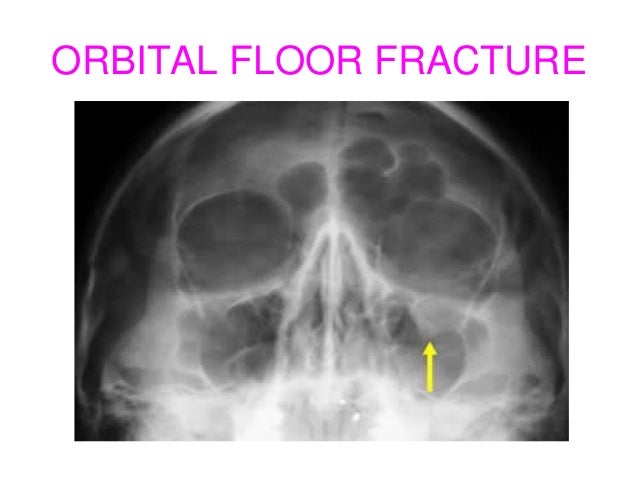 Orbital Floor Fracture