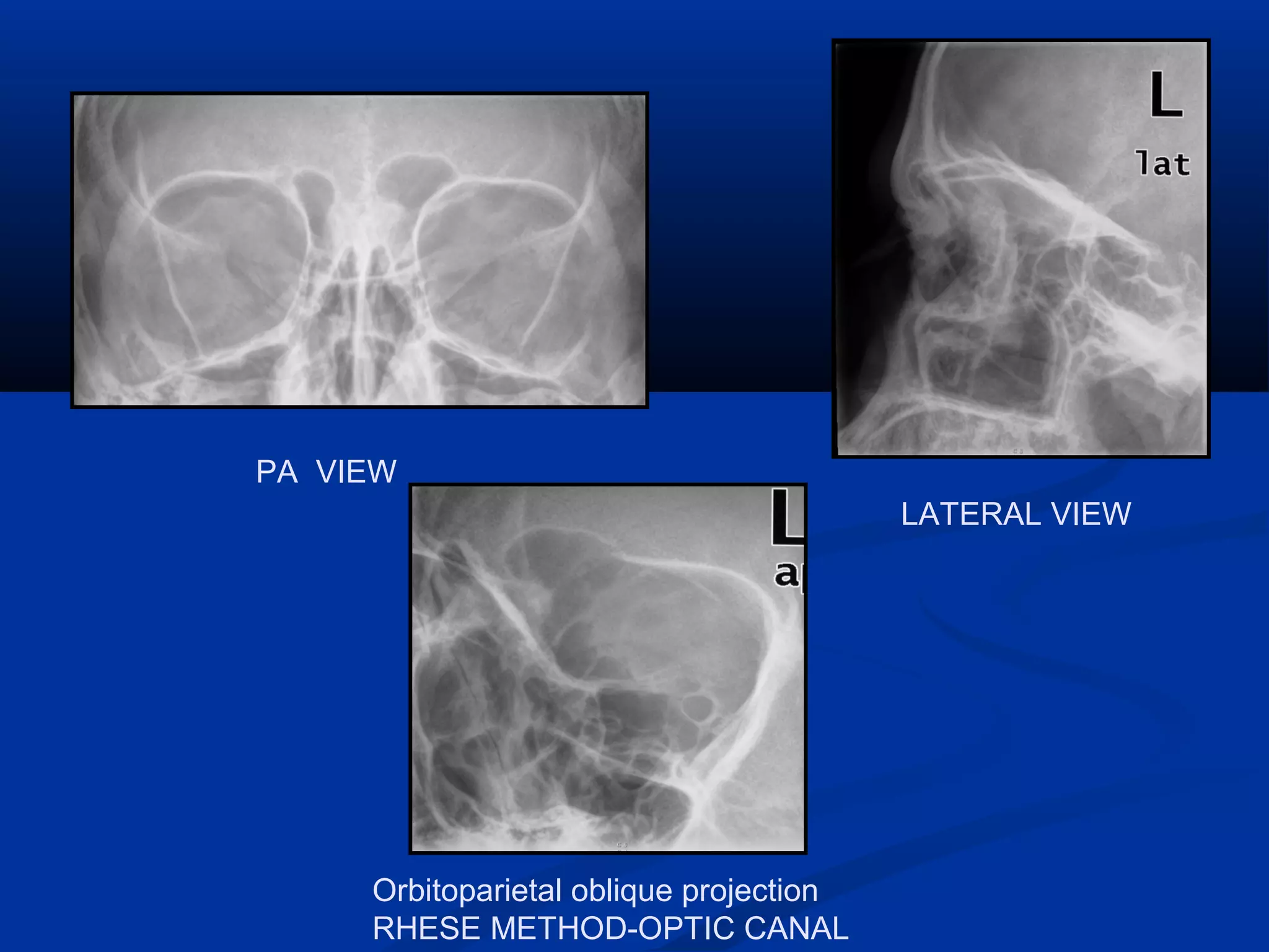Orbital imaging | PPT