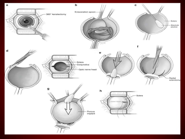 Orbital implants | PPTX | Eye and Vision Conditions | Diseases and ...