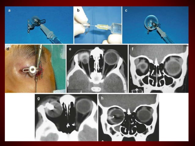 Orbital implants | PPTX | Eye and Vision Conditions | Diseases and ...