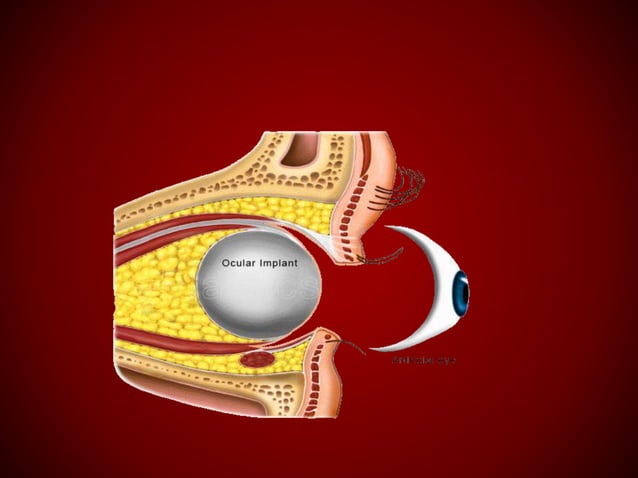 Orbital implants | PPTX | Eye and Vision Conditions | Diseases and ...