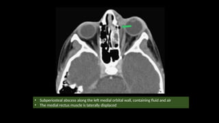 Orbital infection and inflamation new.pptx