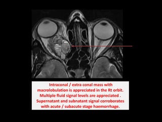 Orbital lymphangioma | PPTX