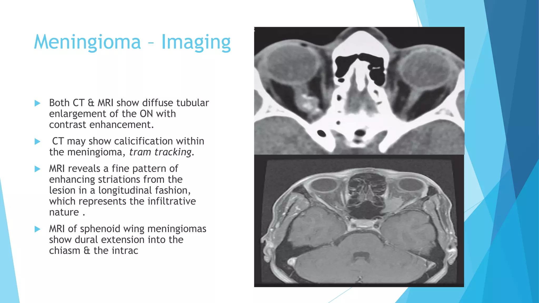 Orbital neoplasms & malformations | PPT