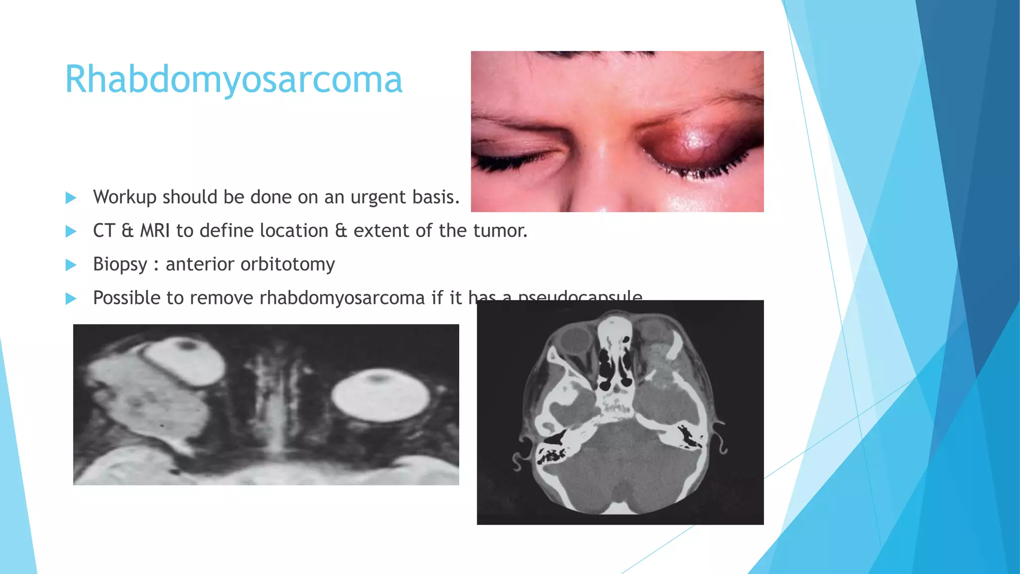 Orbital neoplasms & malformations | PPT