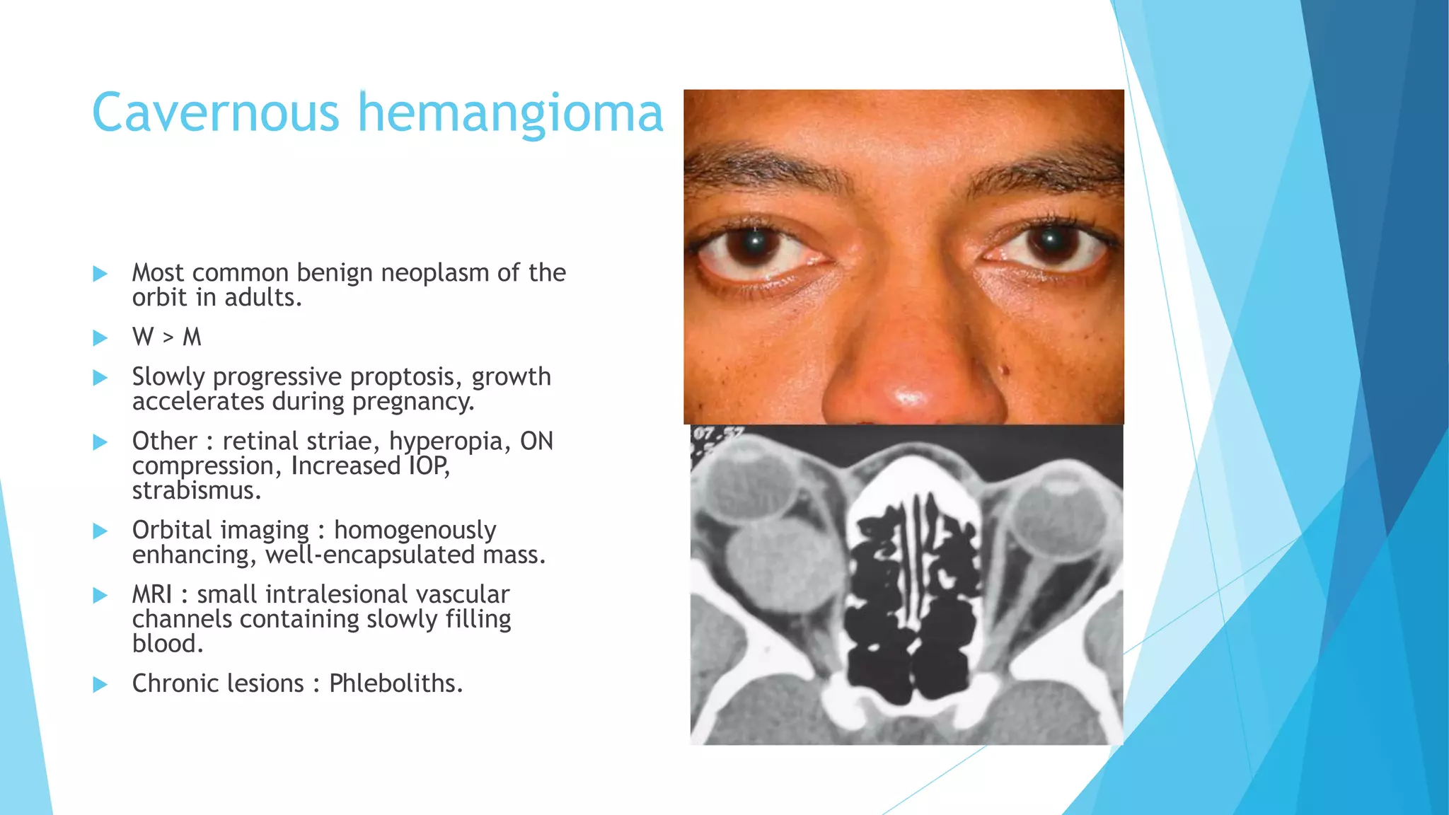 Orbital neoplasms & malformations | PPT | Free Download
