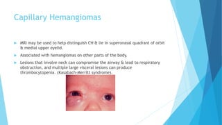Orbital neoplasms & malformations | PPTX