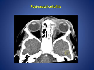 Orbital Septum Radiology