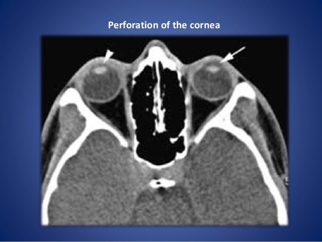 Orbital pathologies radiology