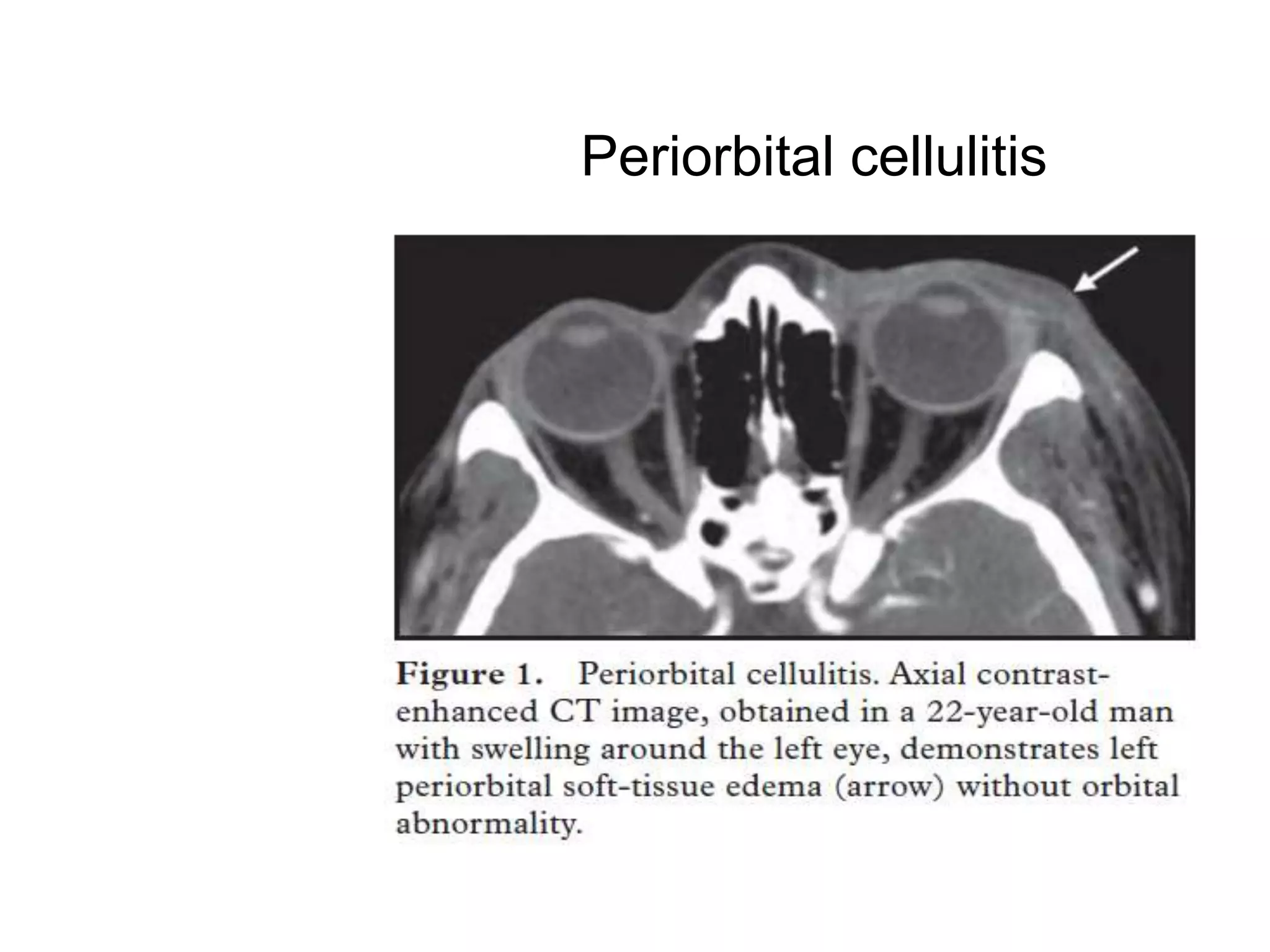 Imaging in orbital pathology | PPTX