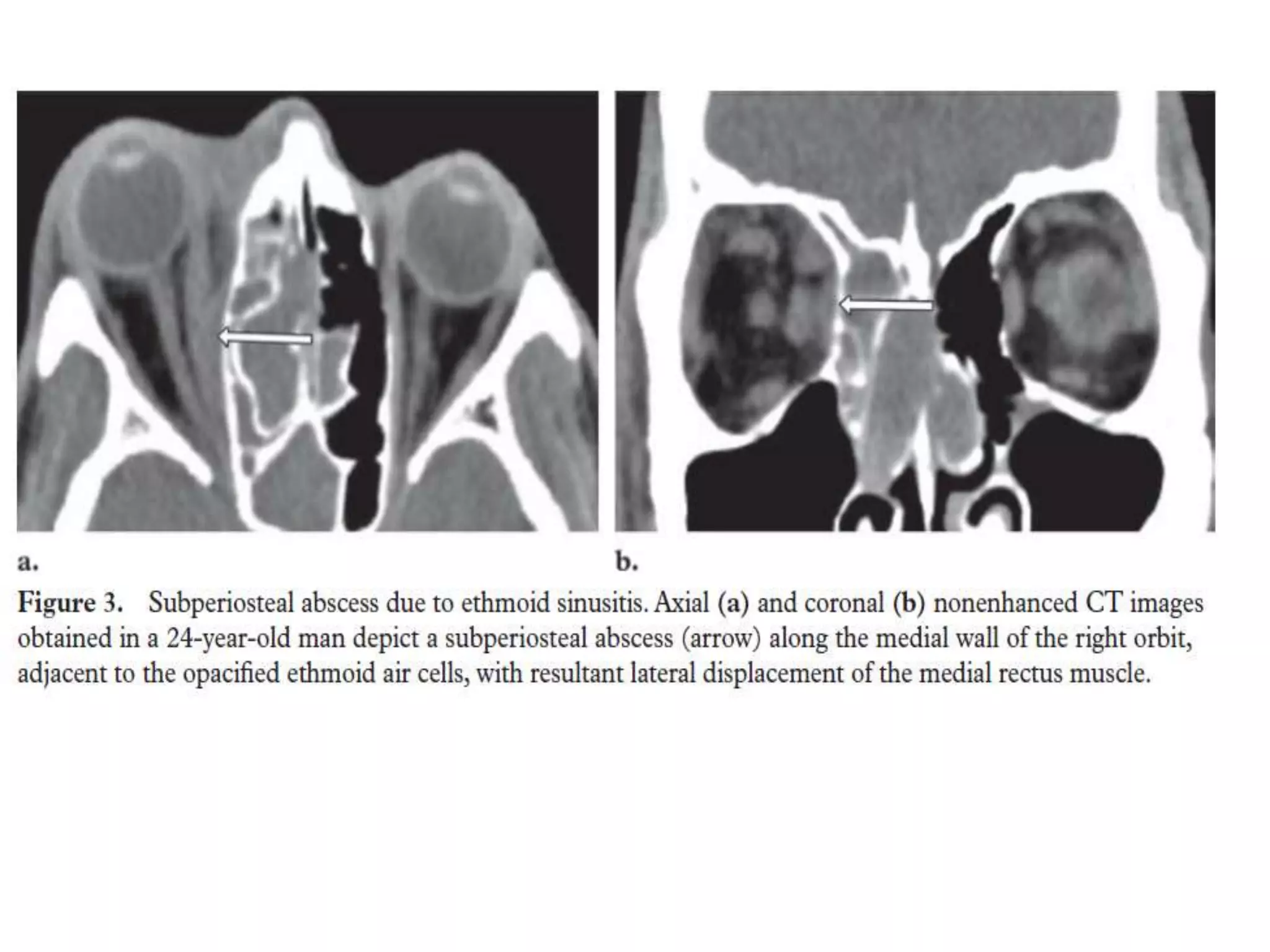 Imaging in orbital pathology | PPTX