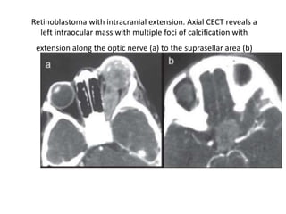 Imaging in orbital pathology | PPTX