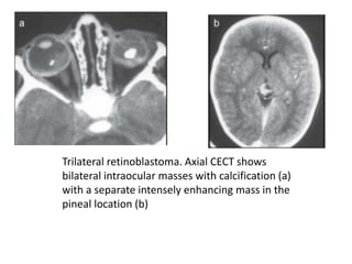 Imaging in orbital pathology | PPTX