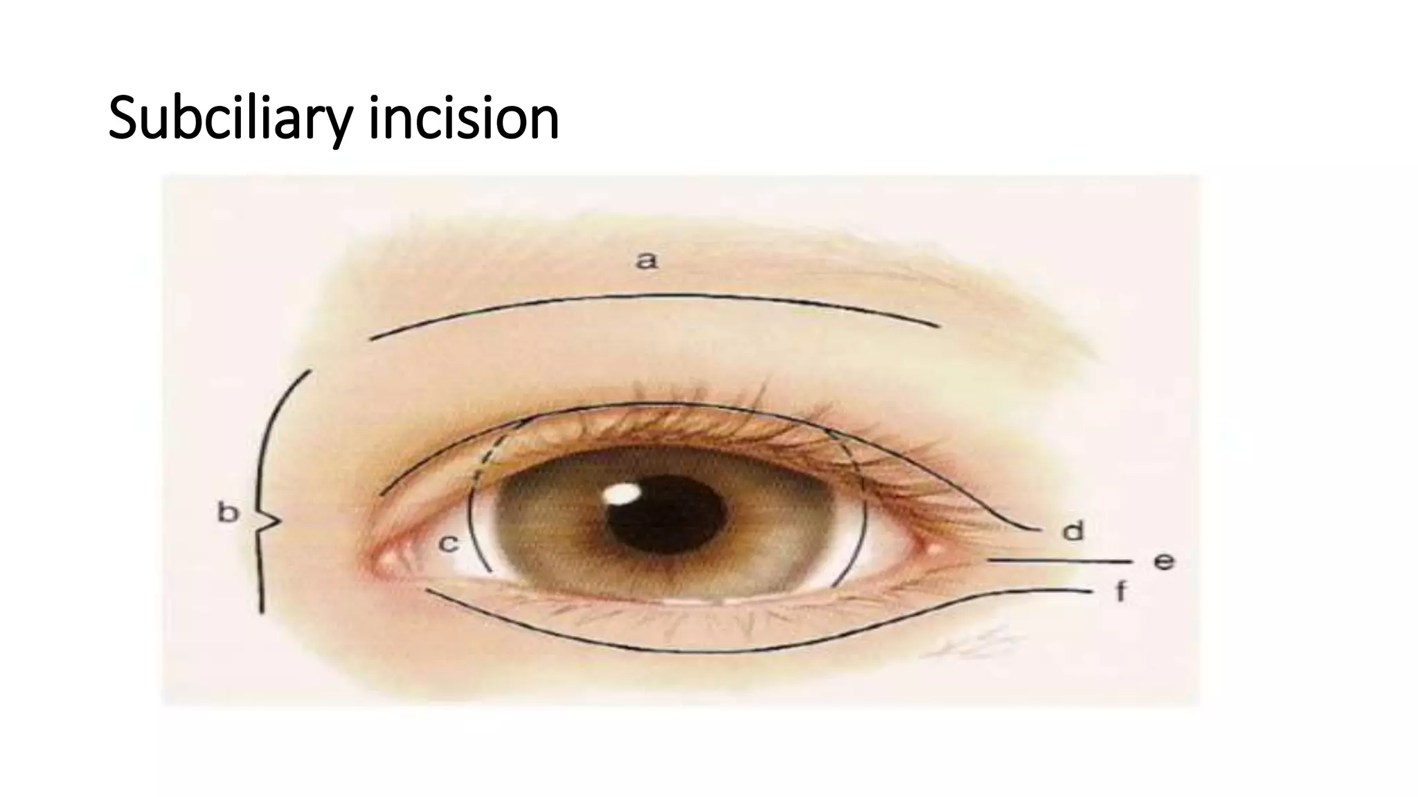 Orbital surgery by Dr. Iddi.pptx