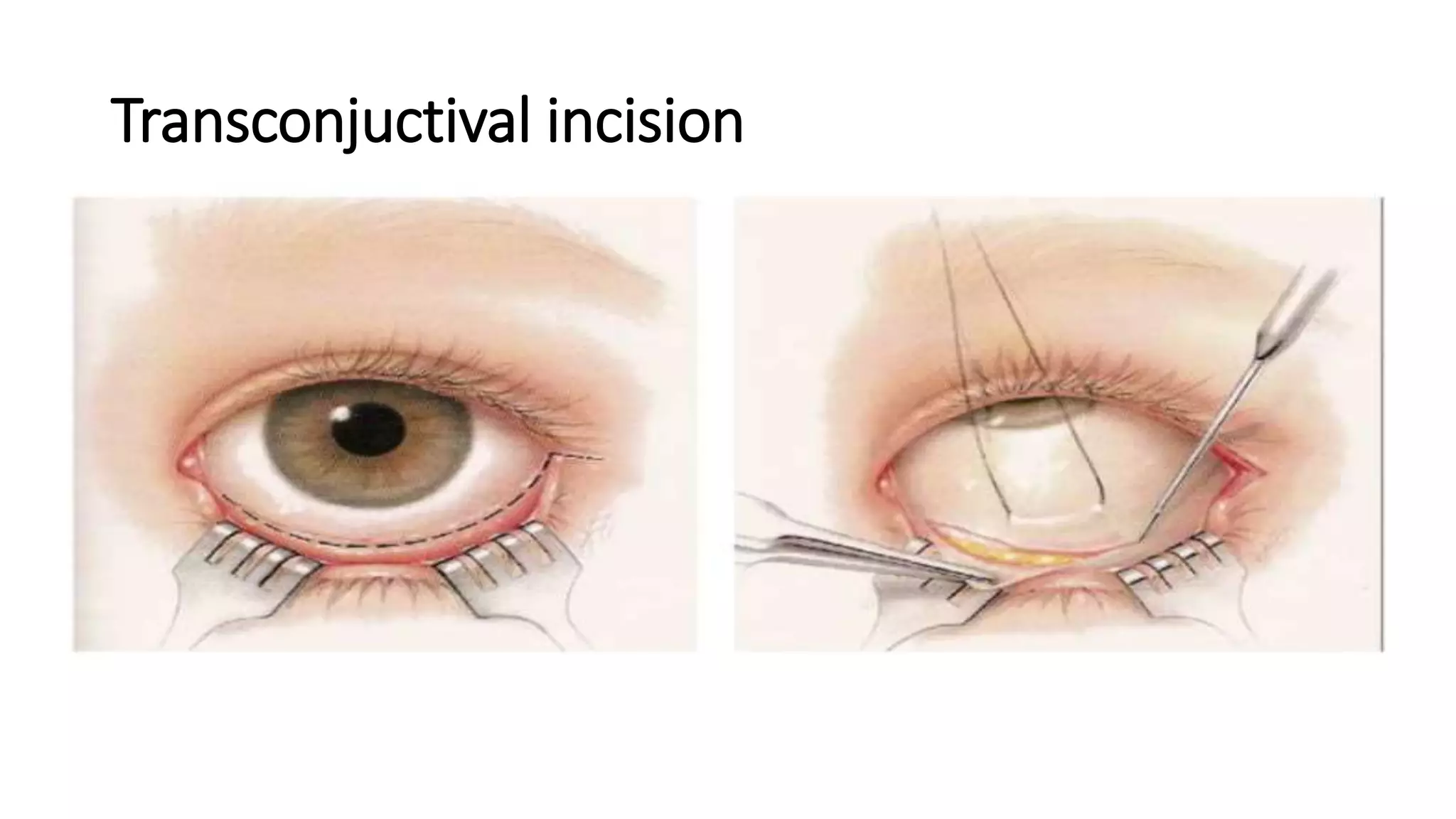 Orbital surgery by Dr. Iddi.pptx