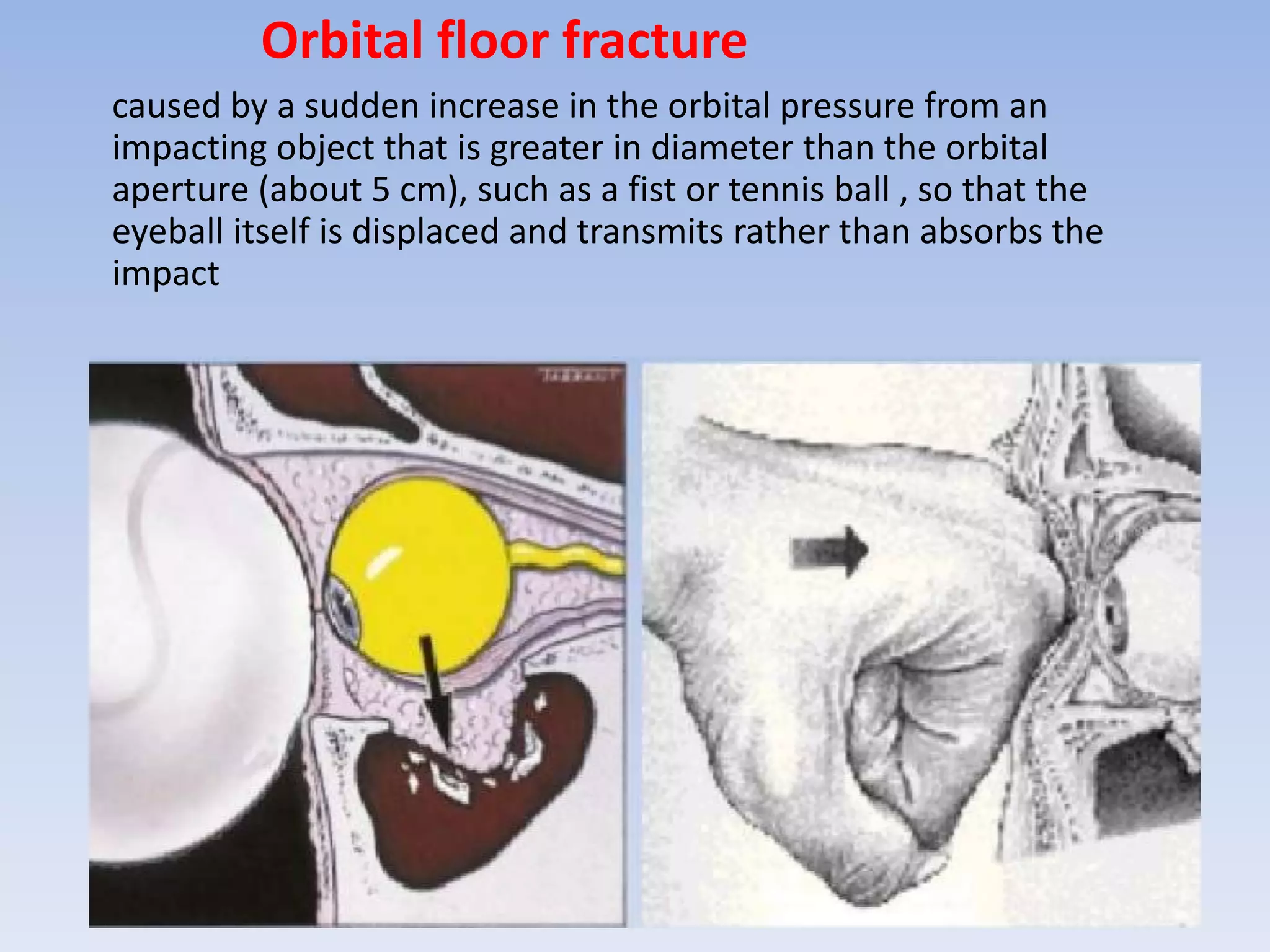 Orbital trauma | PPTX
