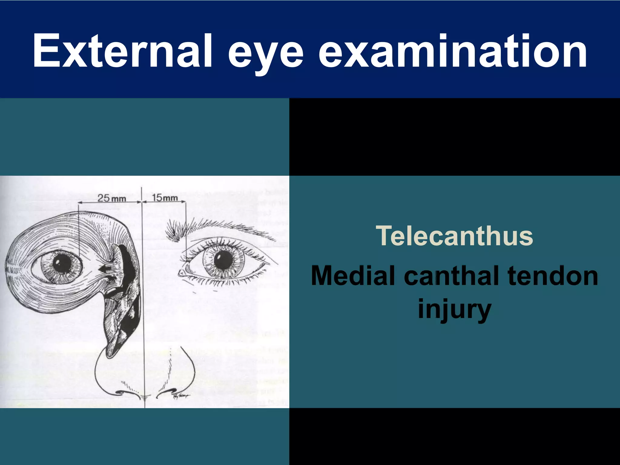 Orbital trauma | PPTX