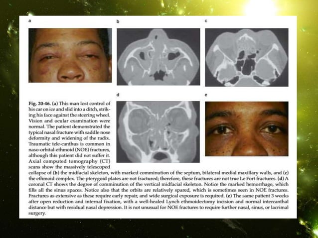 Orbital trauma | PPTX